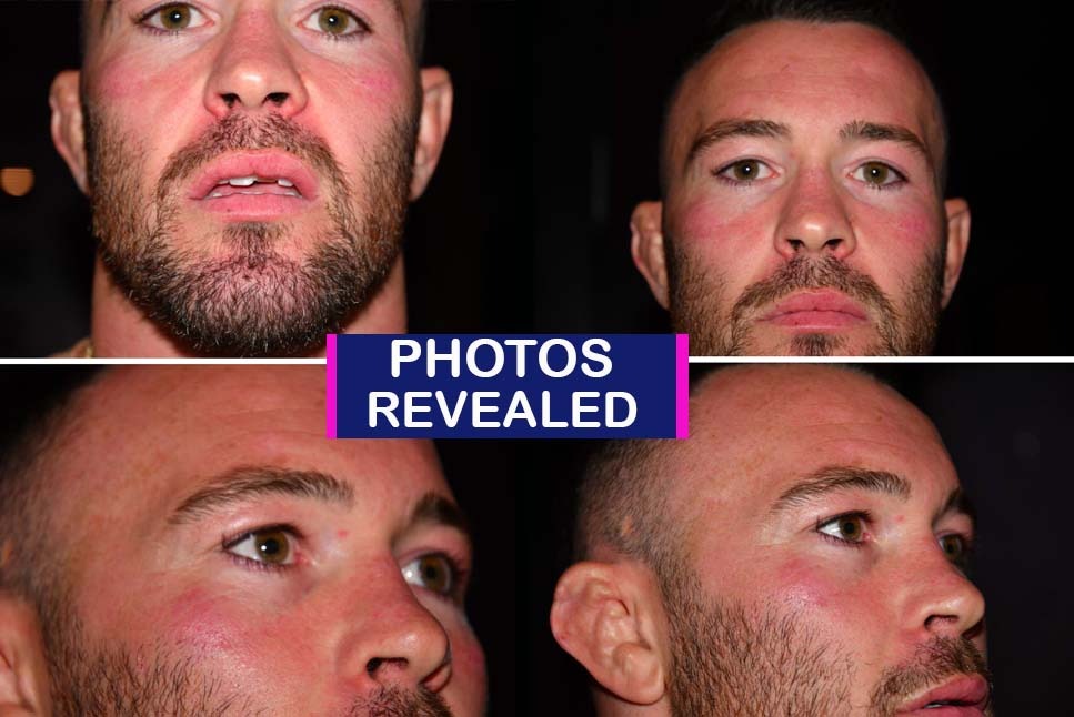 UFC News: Colby Covington's CHIPPED TOOTH Photos revealed